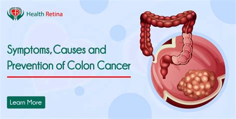Colon Cancer Symptoms Causes And Prevention The Colon Is The Opening