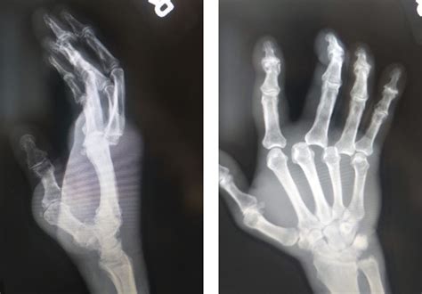 An Unusual Case Of Third And Fourth Metacarpophalangeal Off
