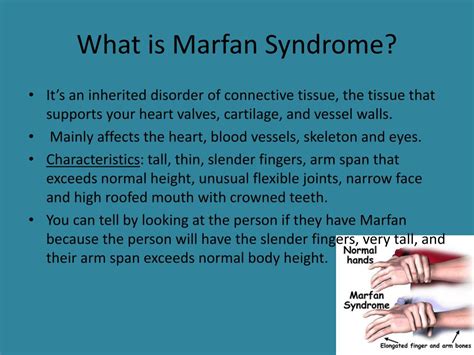 Marfan Syndrome Phelps