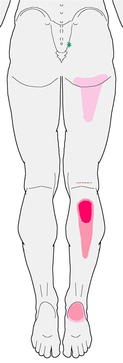 Sacrotuberous Ligament Pain
