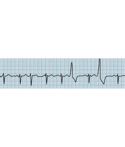 EKG Arrhythmias Flashcards Quizlet