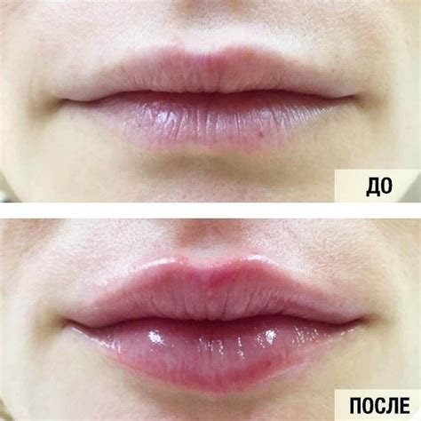 Фото Тонких Губ После Увеличения 1 Мл Mixyfotos ru