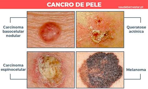 CÂNCER DE PELE INÍCIO MEU CASO REAL Muito Diva