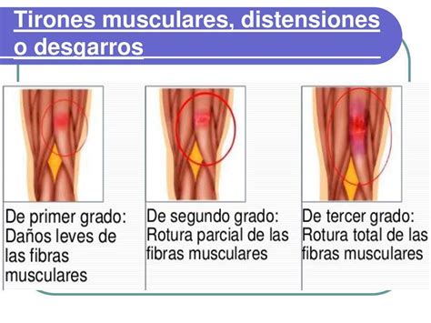 Que Es Un Desgarro Muscular Brainly Lat