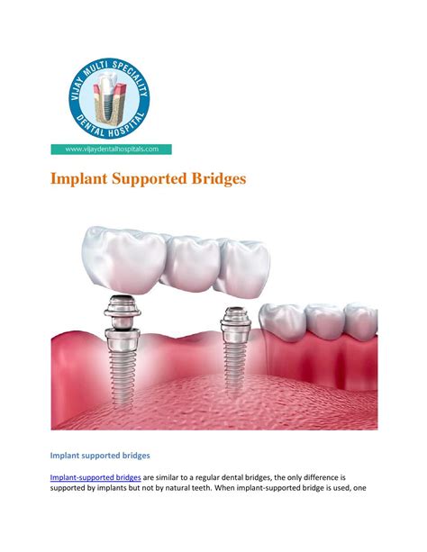 Implant Supported Bridges By Vijay Dental Hospital Issuu