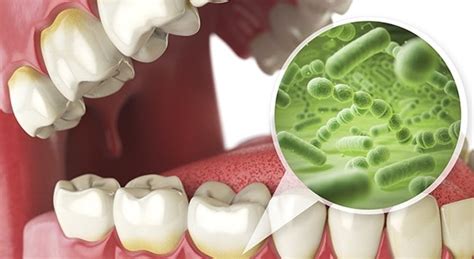 Las 5 enfermedades dentales más comunes Clínica Dental Dra Olga