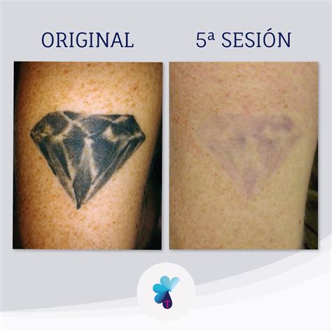 Resultados de procesos de eliminación de tatuajes Tatualia