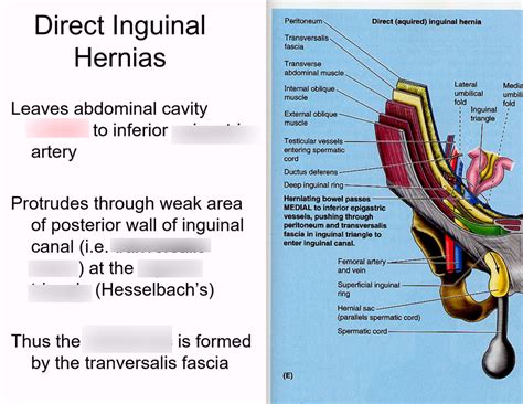 Mod Lec Direct Inguinal Hernias Diagram Quizlet