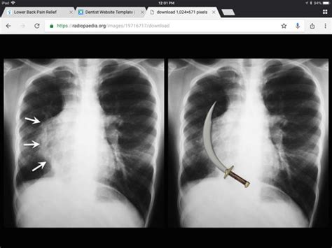 Venous Anomalies Flashcards Quizlet
