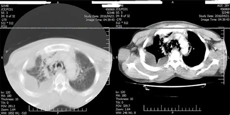 Axial Lung And Mediastinal Window CT Scan Show Loculated Pleural