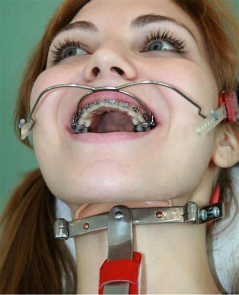 Pictures Showing For Braces Headgear Porn Mypornarchive Net