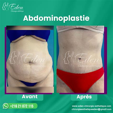 Abdominoplastie Tunisie prix Chirurgie réparatrice du ventre