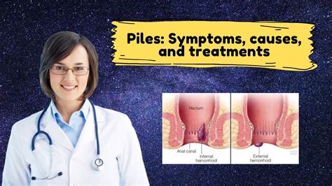 Piles Symptoms Causes And Treatments YouTube