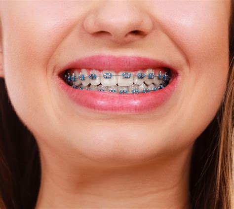 Woman showing her teeth with braces Orthodontie spécialisée de