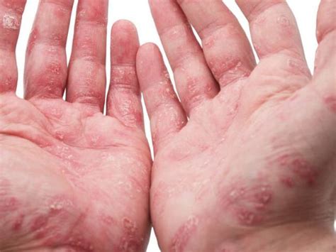 Qué es la psoriasis y cuáles son los tratamientos más efectivos y