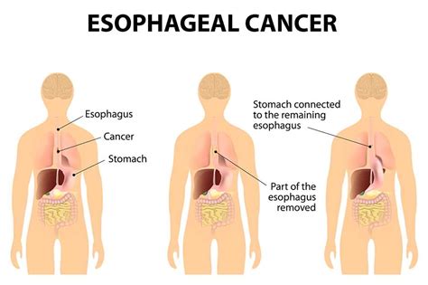 Esophageal Cancer Symptoms Common Signs Of Esophageal Cancer