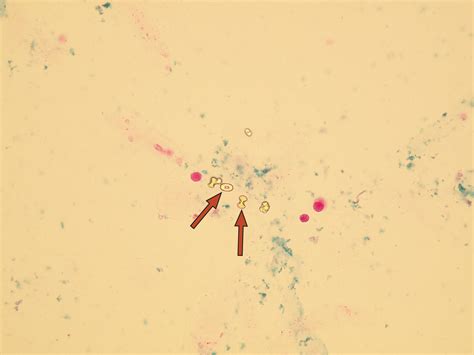 Calcium Oxalate In Urine