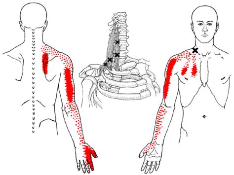 Puntos Gatillo Que Son Y Tratamiento Con Fisioterapia