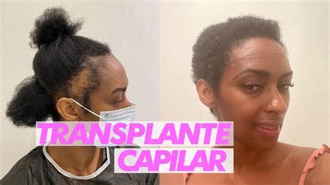 Transplante Capilar Feminino Resultado Antes E Depois Youtube
