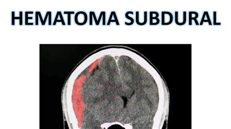 Hematoma Subdural Abraham P Rez P Rez Udocz