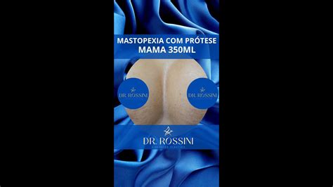 MASTOPEXIA PRÓTESE 350ML YouTube