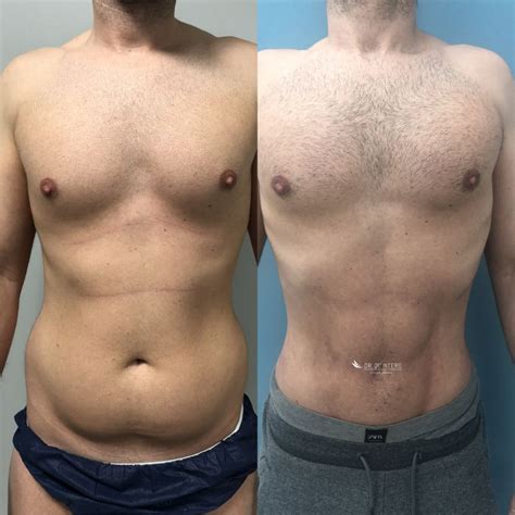 Lipo VASER de Alta Definición en Madrid Dr Edgar Quintero