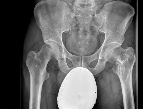 Intertrochanteric Fractures Trauma Orthobullets