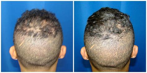 Patient Neograft Before And After Photos Houston Tx Plastic