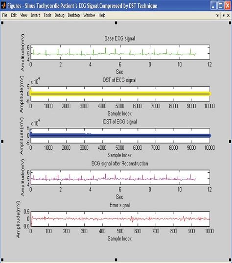 figure 1 1 from ecg signal compression using efficient transformations semantic scholar
