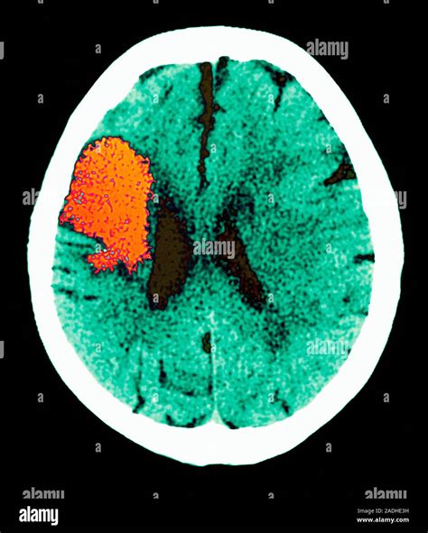 Stroke Coloured Computed Tomography CT Scan Of A Cerebrovascular