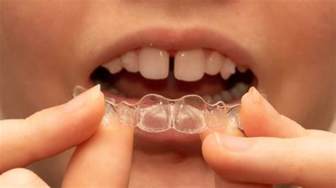 Treatment Options For Replacing A Missing Tooth Medicantology