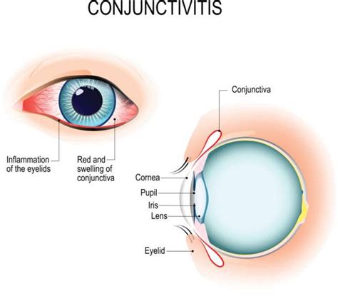 Conjunctivitis Or Pink Eye Cases Rise Causes Symptoms And Preventions
