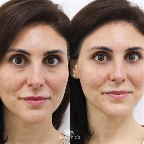 Relleno de ojeras con ácido hialurónico precio y beneficios
