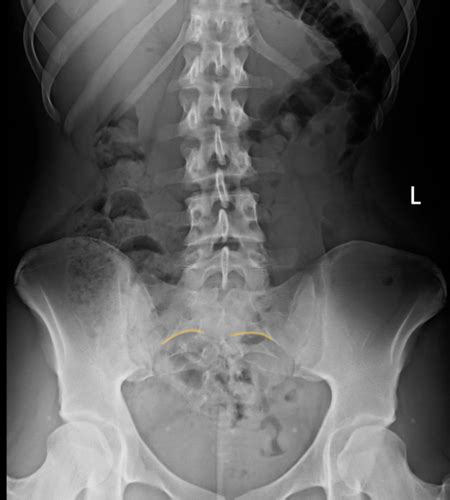 Lumbar Spine Flashcards Quizlet
