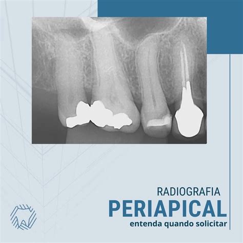 Radiografia Periapical Entenda Quando Solicitar Studio Rx