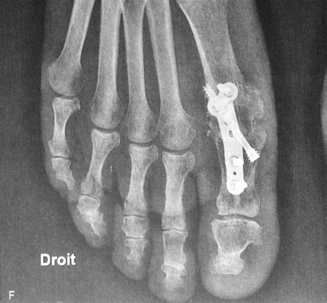 Hallux rigidus Clinique Ostéo Articulaire des Cèdres Grenoble