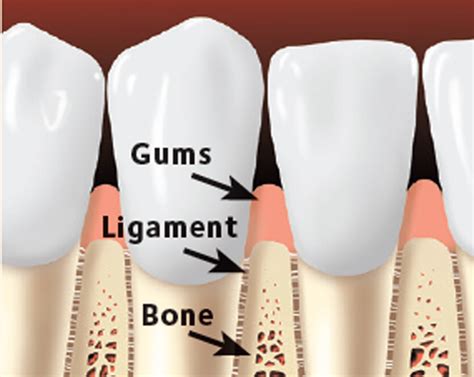Periodontal Gum Disease Treatment Metzger Dentistry