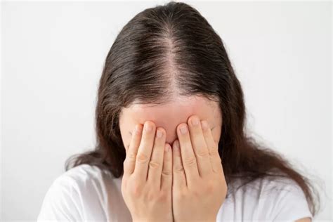 Alopecia Feminina o que é causas e como tratar Adoro Maquiagem