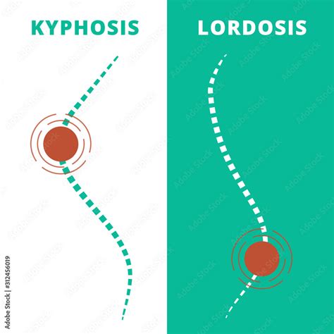 Diseases Of The Spine Spinal Pain Lordosis Kyphosis Body Posture