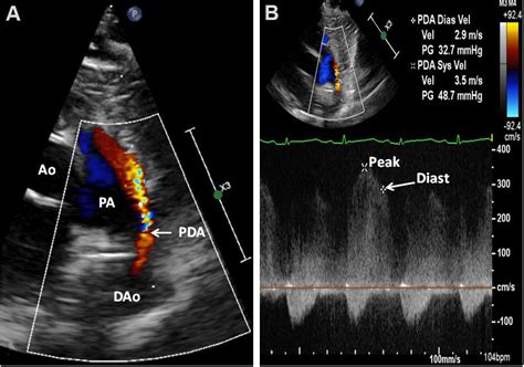 Echocardiographic Study In Parasternal Short Axis Projections Featuring