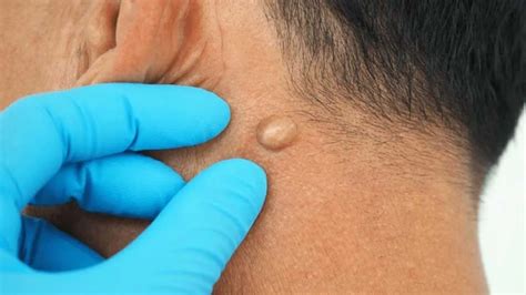 Sebaceous Cyst Treatment Epidermoid Cyst Removal Clear Skin