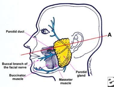 Parotid Duct Injuries Practice Essentials History Of The Procedure