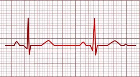 La Importancia De Hacerte Un Electrocardiograma CEEAD Laboratorios