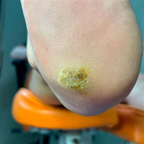Verruga Plantar Sintomas e Tratamentos Centro Clínico do Pé