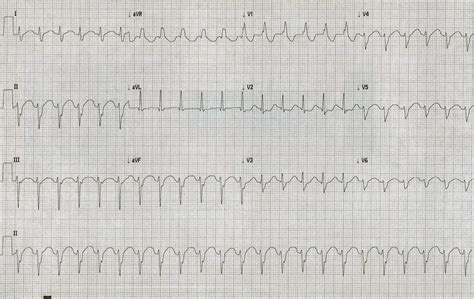 Dr Smith S ECG Blog Wide Complex Tachycardia What Is The Diagnosis