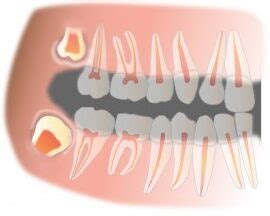 Cuánto dura el efecto de la anestesia dental en una muela