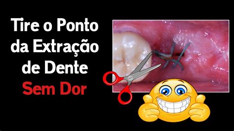 Como Tirar os Pontos do Dente Sozinho em Casa Extração Dentária YouTube