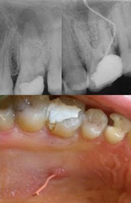 F Stula De Absceso Periapical