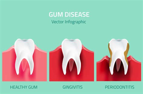 How To Tell If You Have Gum Disease Dr Kevin Sands