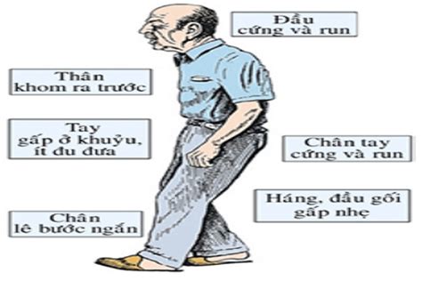 Tri U Ch Ng B Nh Parkinson Nh N Di N S M C Ph Ng Ph P I U Tr